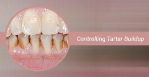 How To Control Tartar Buildup | Pearl Dental Burlington